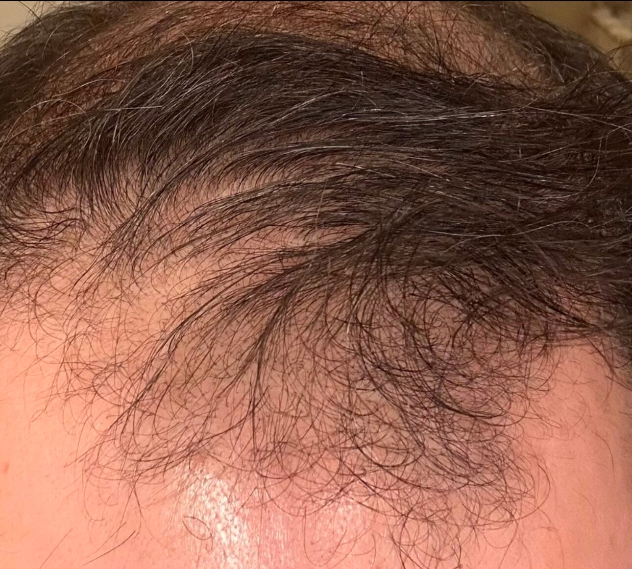 Dr. Bloxham - 2 FUTs + FUE temple points, 7350 grafts - Hair Transplant ...