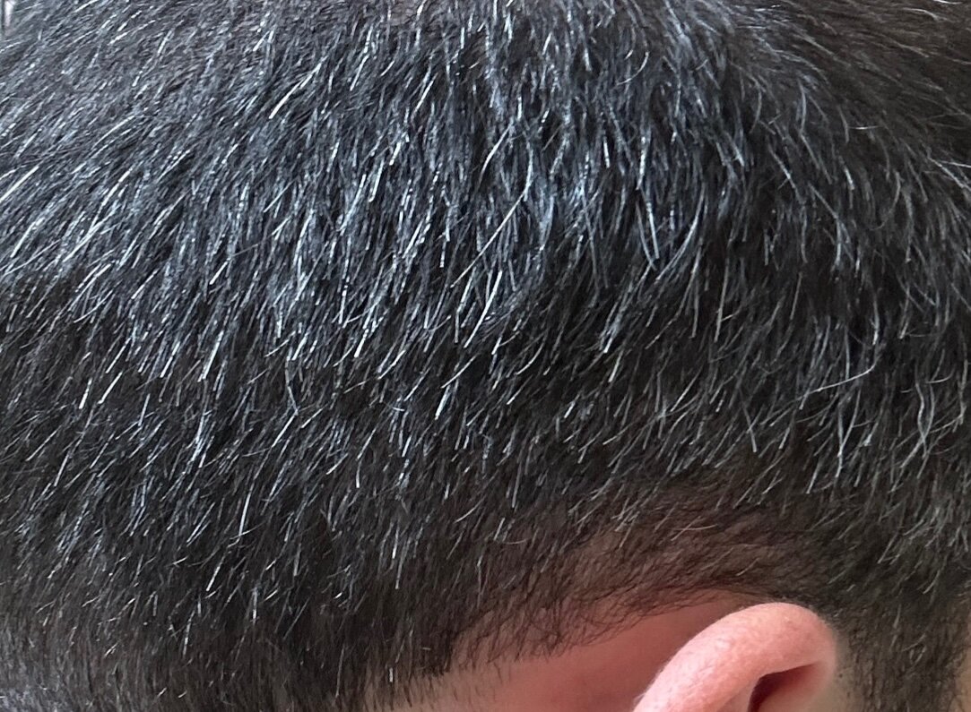 Dr. Bloxham - 2 FUTs + FUE temple points, 7350 grafts - Hair Transplant ...