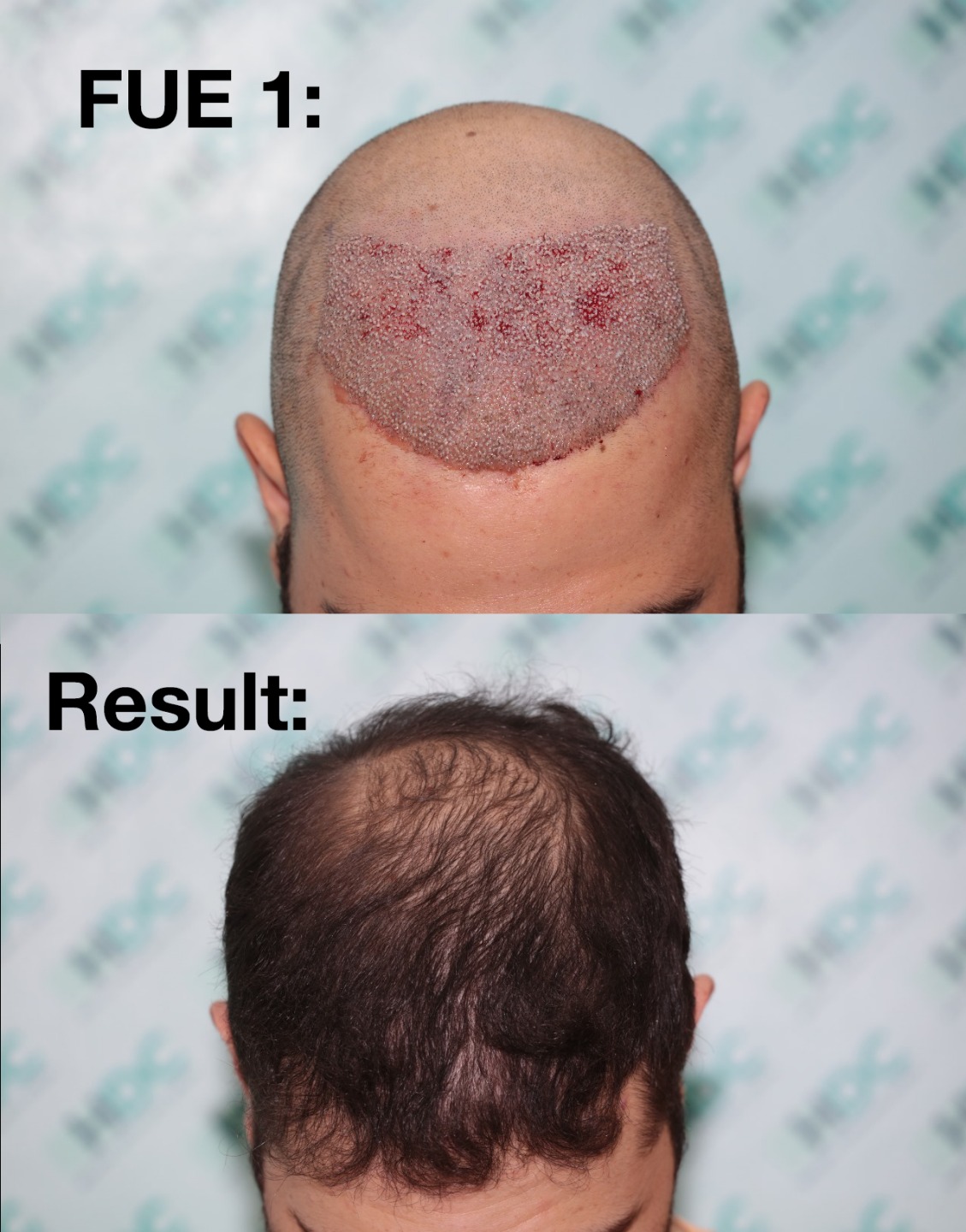 Dr. Christina Vryonidou (HDC Cyprus) -- 7900 FUE Grafts, 2 Surgeries ...