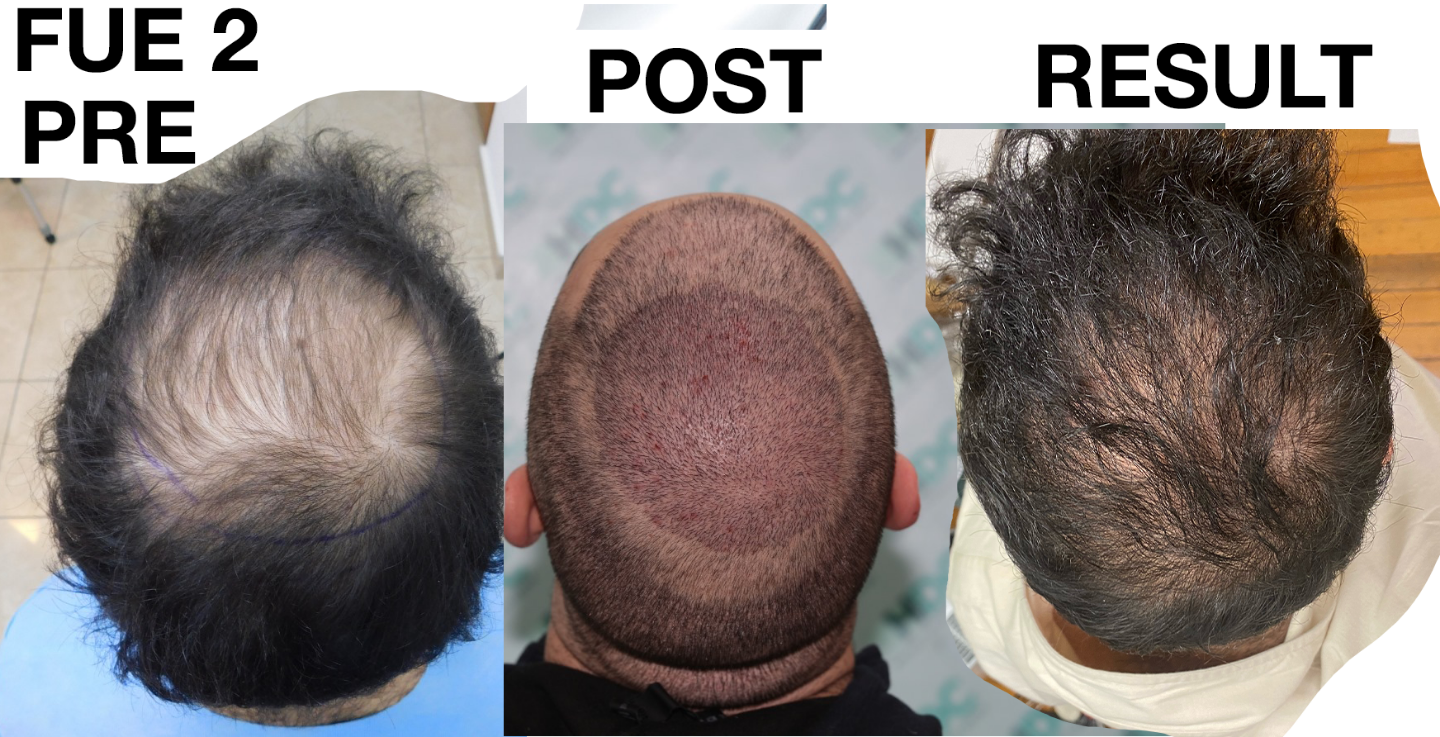 Dr. Christina Vryonidou (HDC Cyprus) -- 7900 FUE Grafts, 2 Surgeries ...