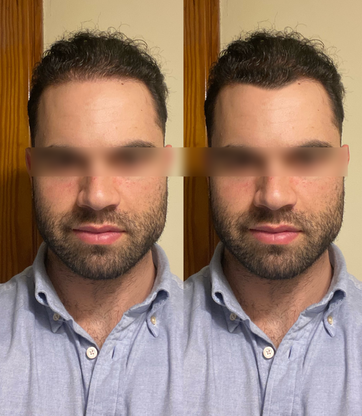 Dr. Christina Vryonidou (HDC Cyprus) -- 7900 FUE Grafts, 2 Surgeries ...