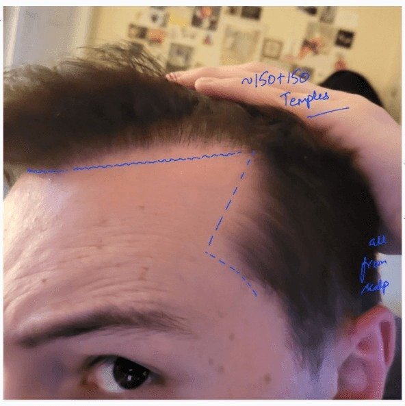 Recommended doctor/clinic for a second hair transplant? Temples ...