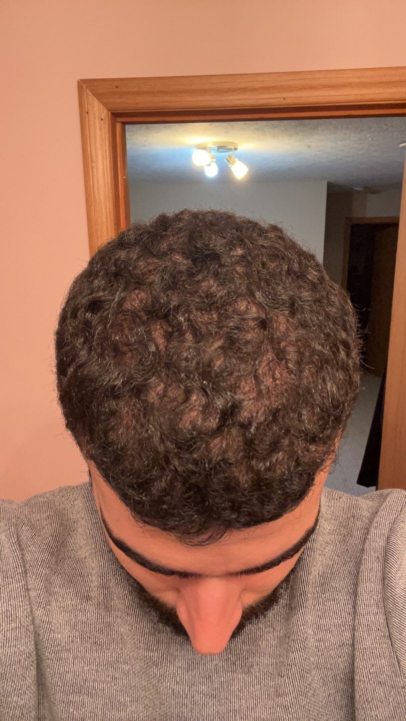 Hair Transplant With Robert Haber - Hair Transplant Reviews - Hair ...
