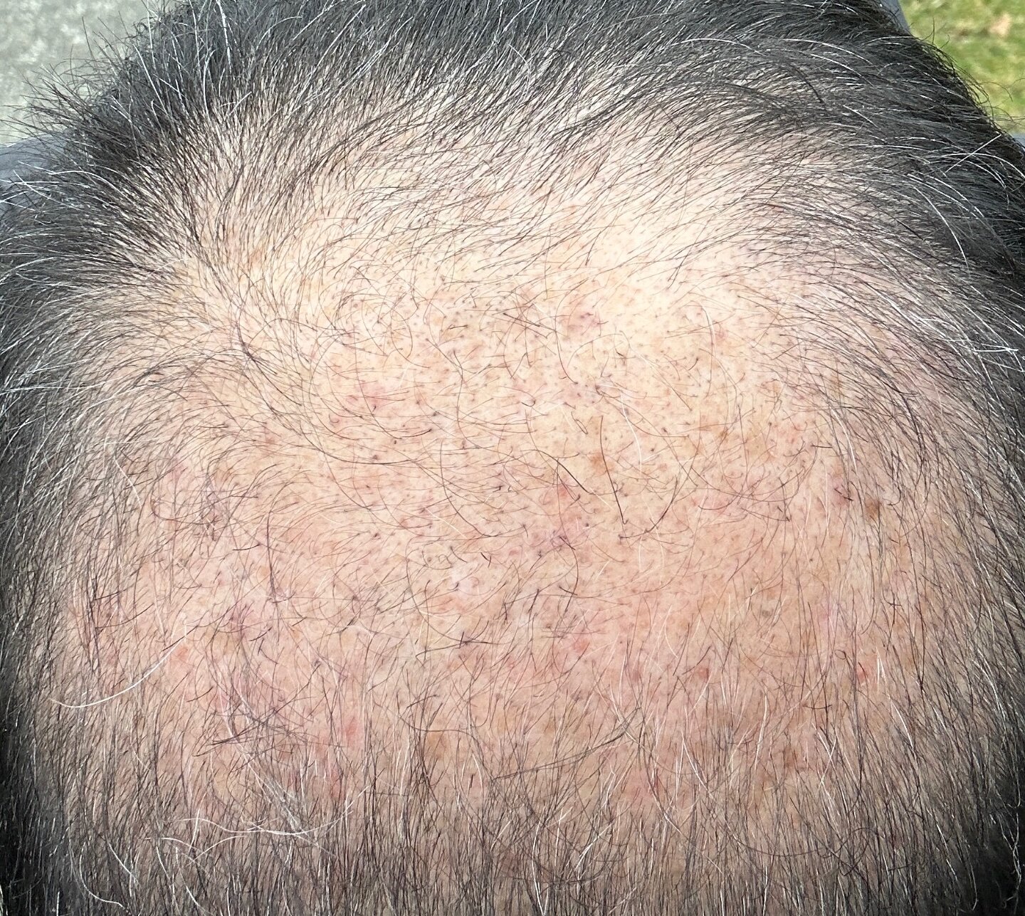 Dr. Bloxham - 2 FUTs + FUE temple points, 7350 grafts - Page 2 - Hair ...