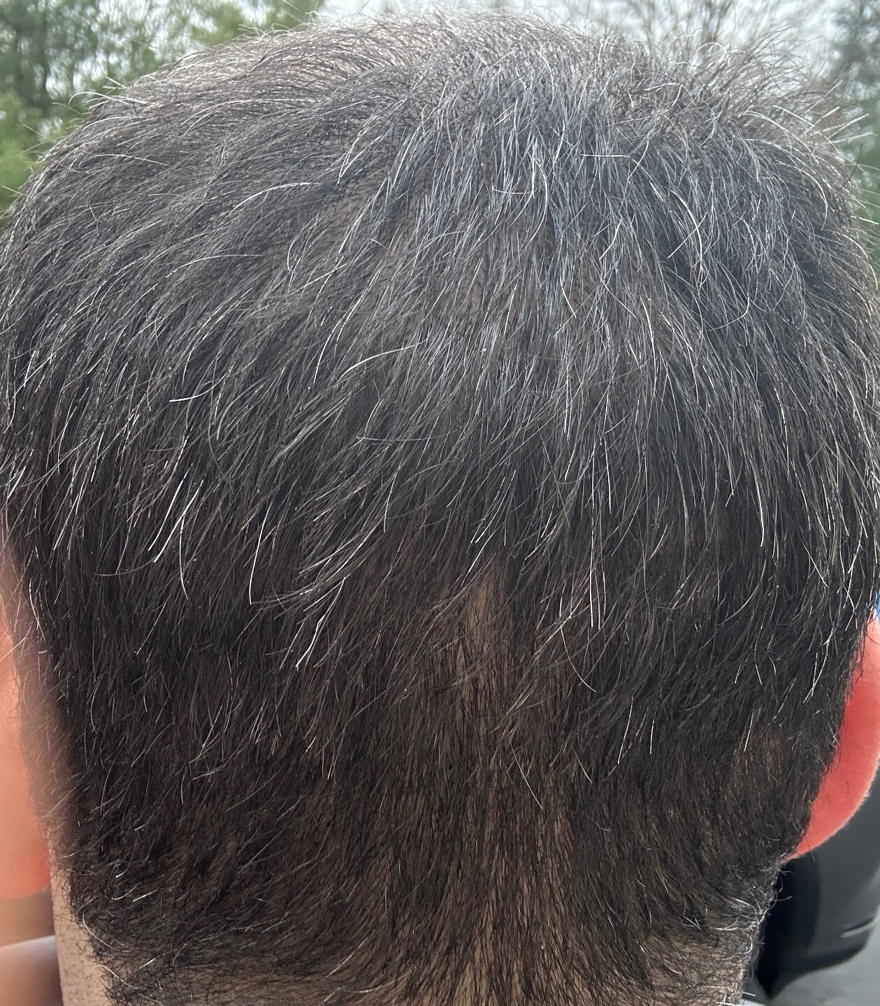 Dr. Bloxham - 2 FUTs + FUE temple points, 7350 grafts - Page 2 - Hair ...