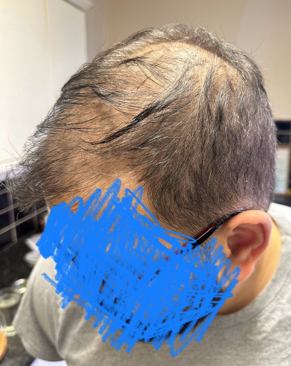 Am I suitable for a hair transplant? - Hair Restoration Questions and ...