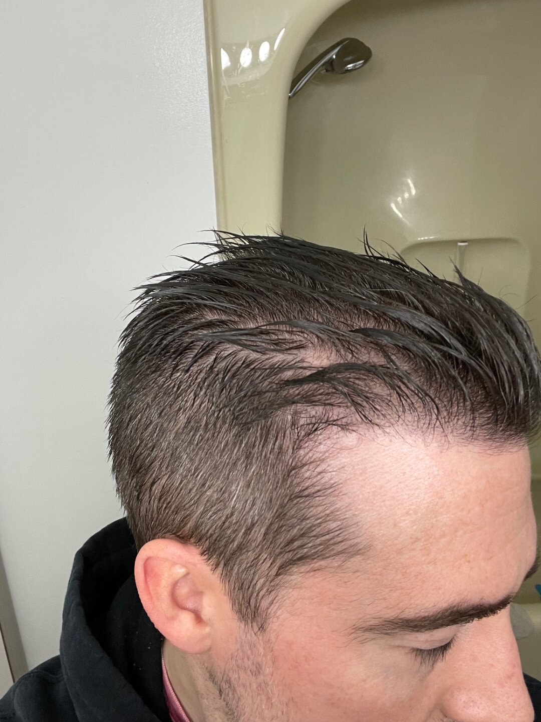 2704 grafts, hairline reconstruction + mid scalp @ Eugenix with Dr. Das ...
