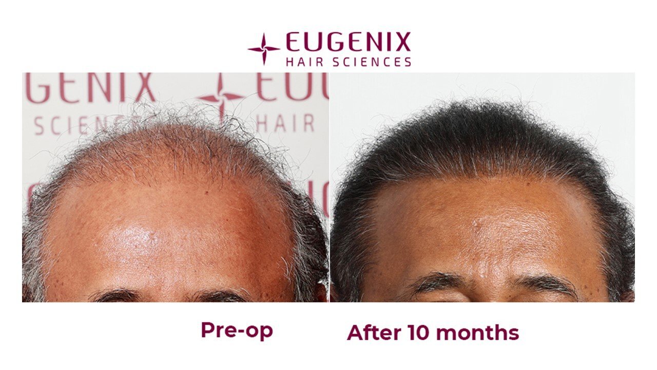 Eugenix Hair Transplant Clinic | NW 7 | 6309 Grafts | 10 Months Post-op ...