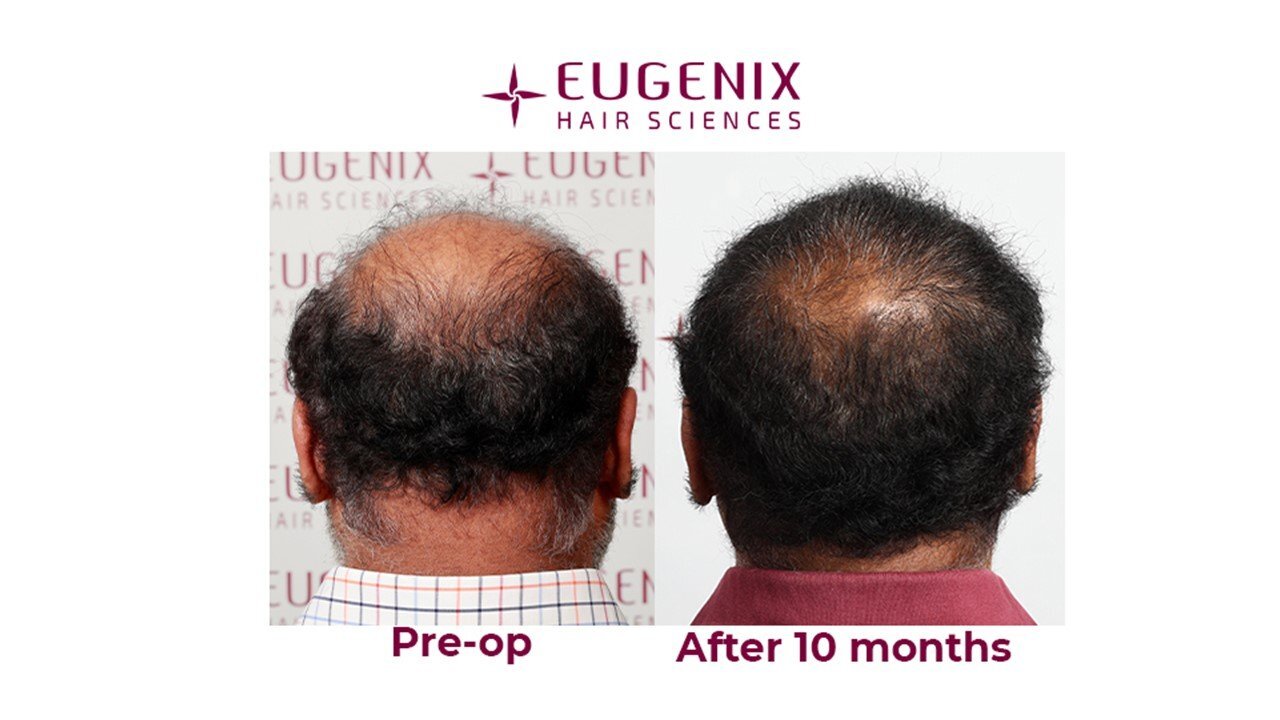 Eugenix Hair Transplant Clinic | NW 7 | 6309 Grafts | 10 Months Post-op ...