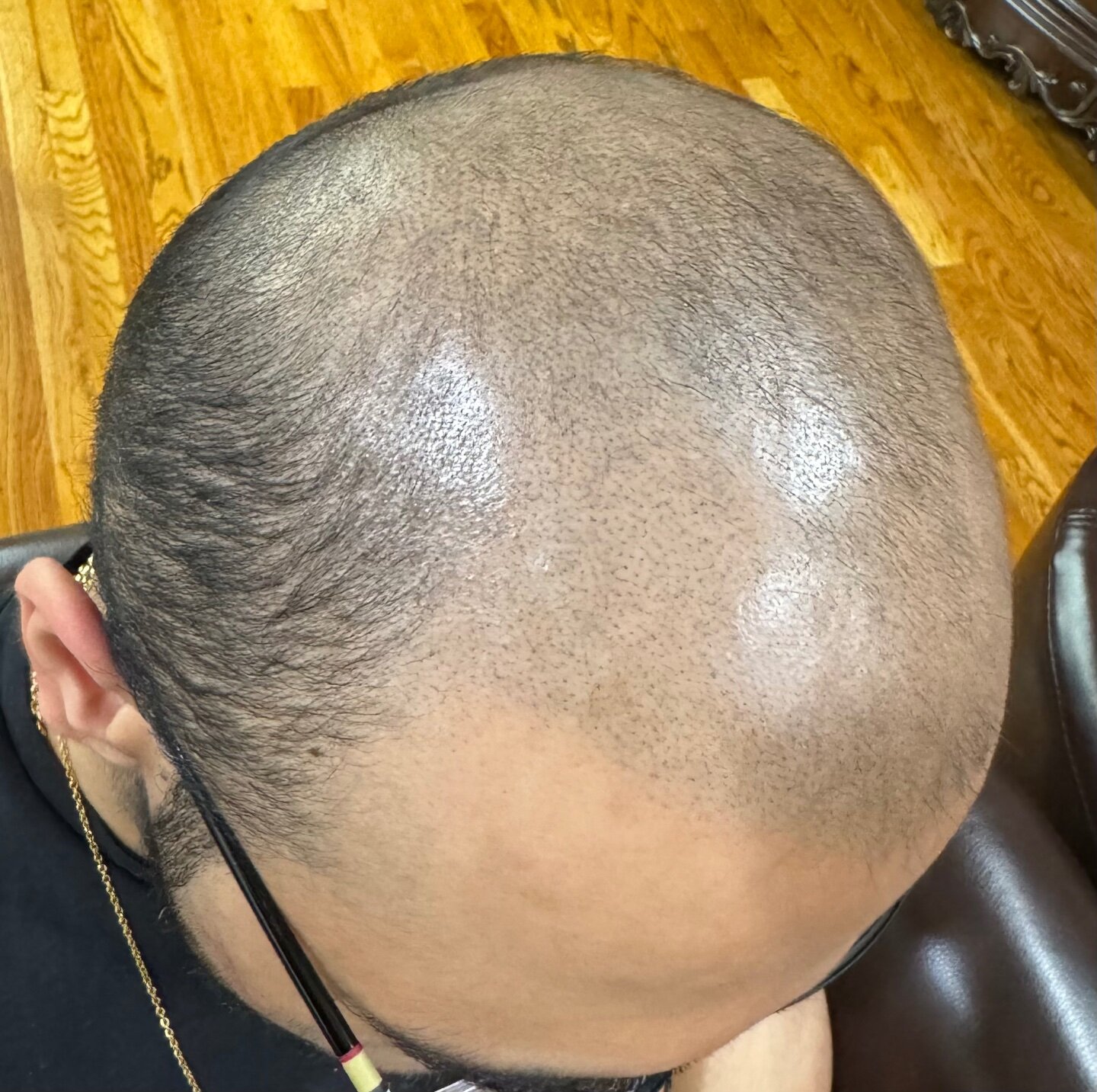 Eugenix | Dr Das | NW7 | 3500 grafts | March 2024 - Hair Transplant ...