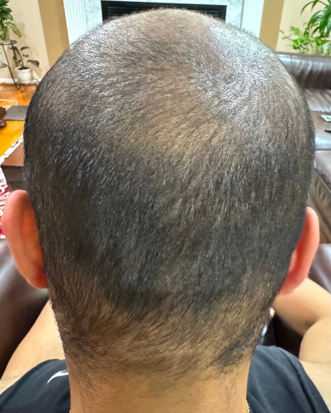Eugenix | Dr Das | NW7 | 3500 grafts | March 2024 - Hair Transplant ...