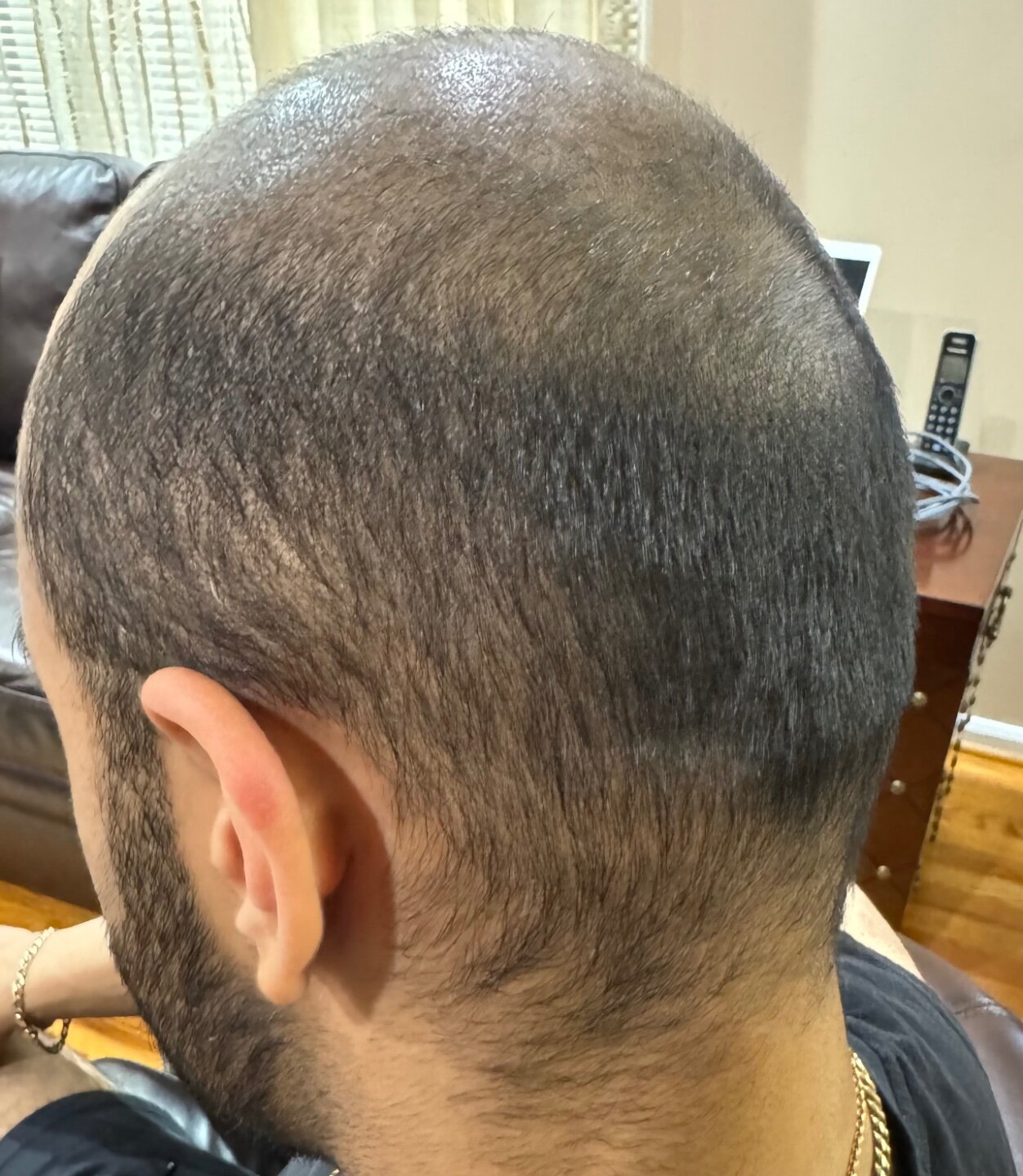 Eugenix | Dr Das | NW7 | 3500 grafts | March 2024 - Hair Transplant ...