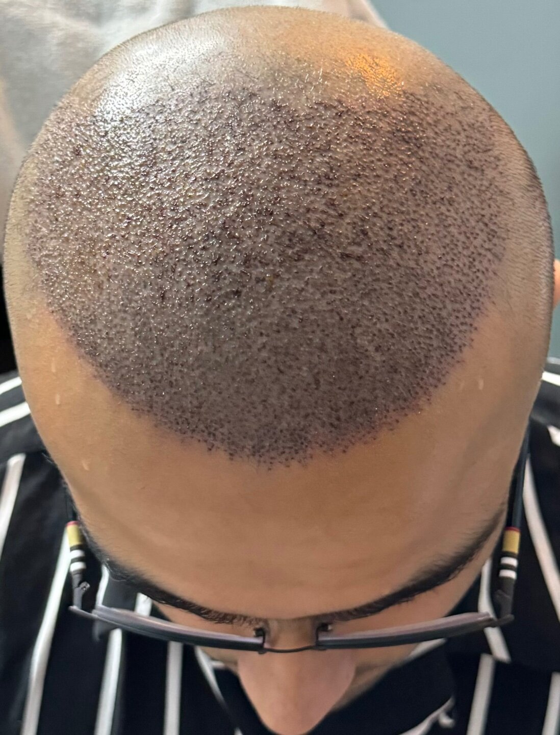 Eugenix | Dr Das | NW7 | 3500 grafts | March 2024 - Hair Transplant ...