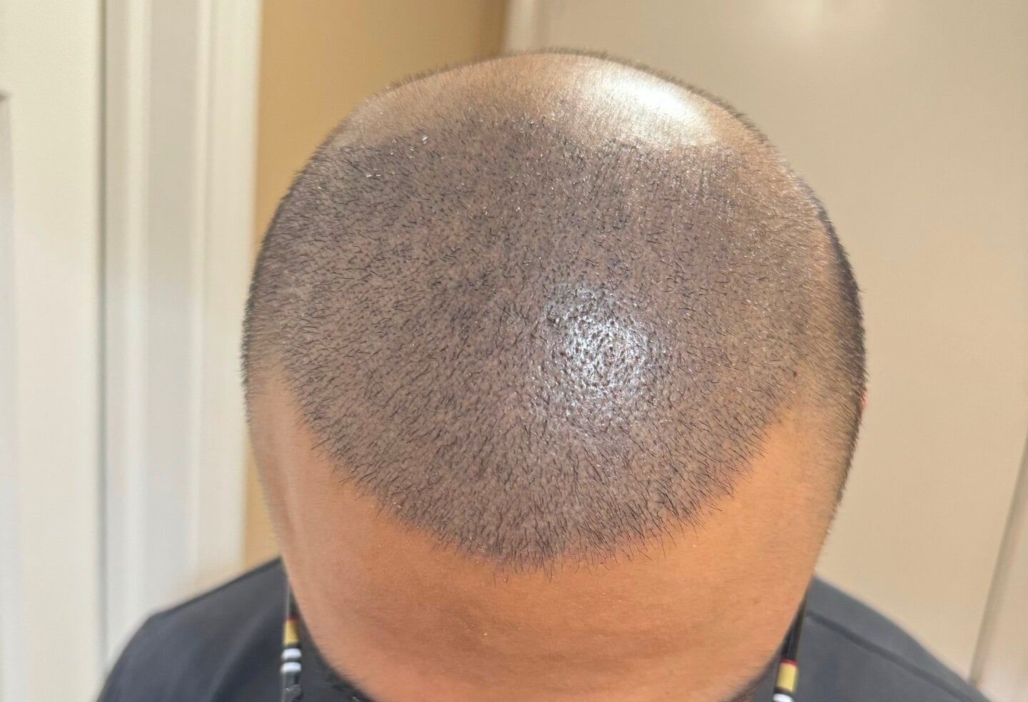 Eugenix | Dr Das | NW7 | 3500 grafts | March 2024 - Hair Transplant ...