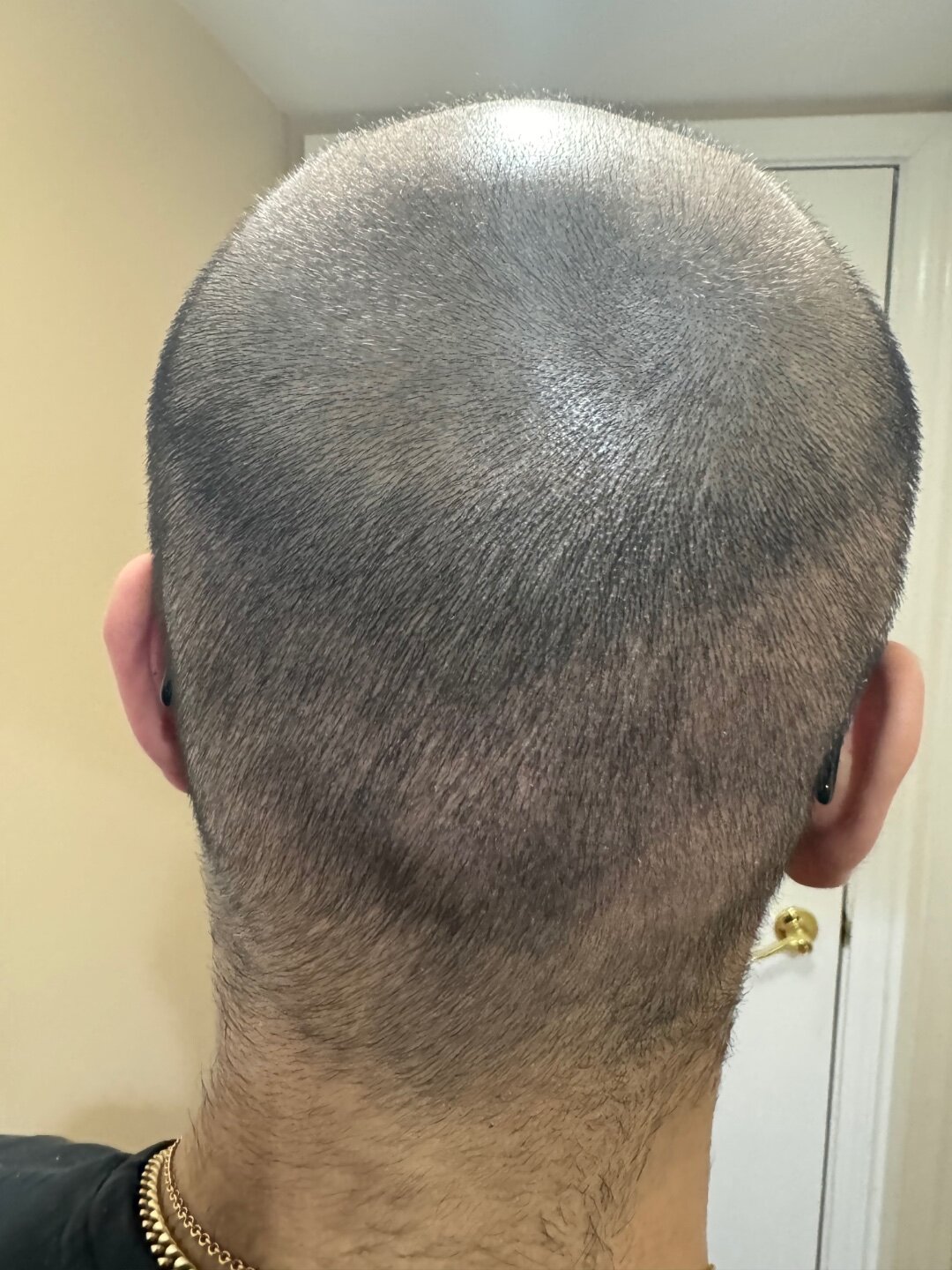 Eugenix | Dr Das | NW7 | 3500 grafts | March 2024 - Hair Transplant ...