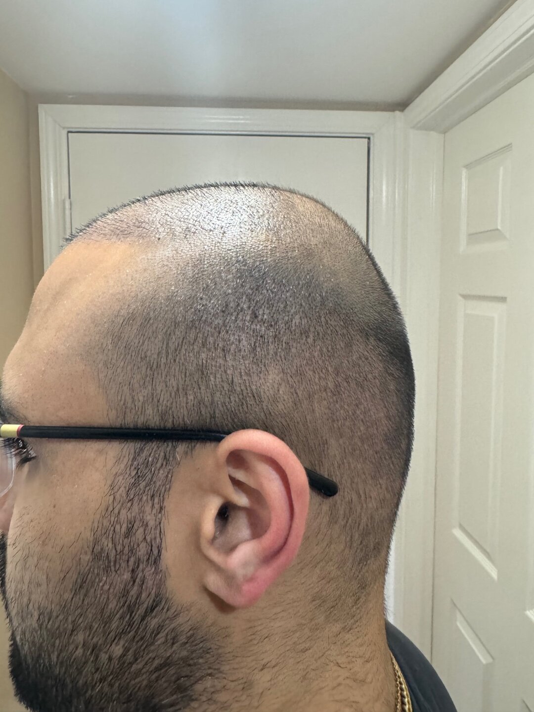 Eugenix | Dr Das | NW7 | 3500 grafts | March 2024 - Hair Transplant ...