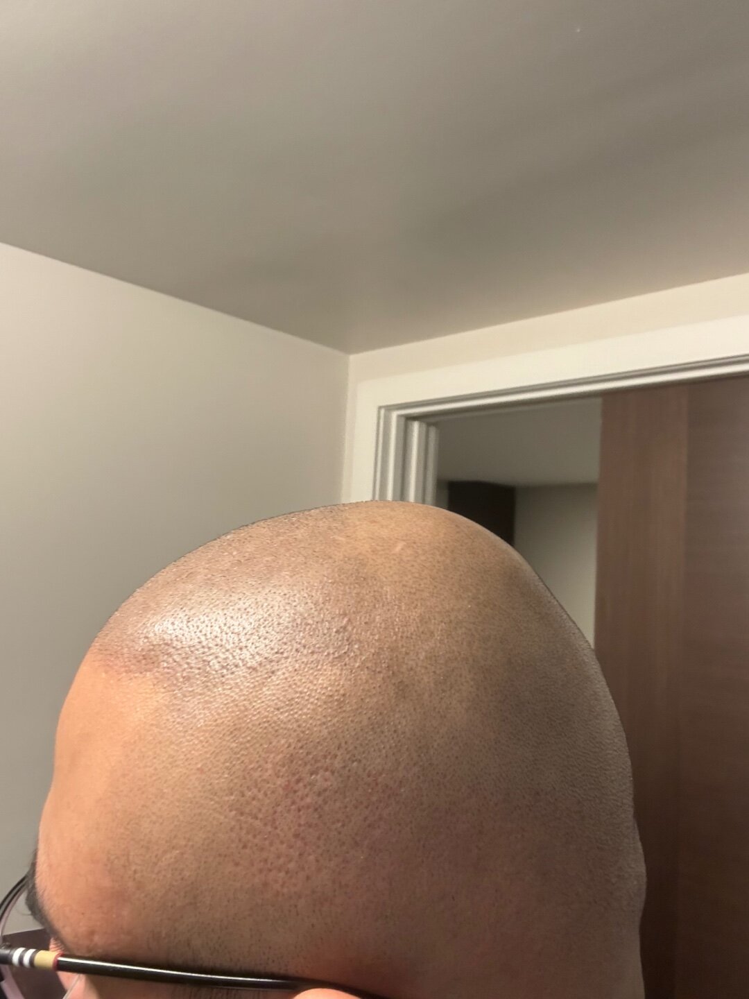 Eugenix | Dr Das | NW7 | 3500 grafts | March 2024 - Hair Transplant ...