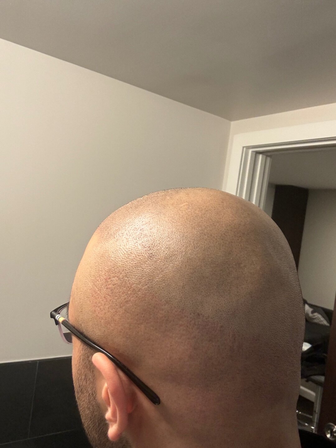 Eugenix | Dr Das | NW7 | 3500 grafts | March 2024 - Hair Transplant ...
