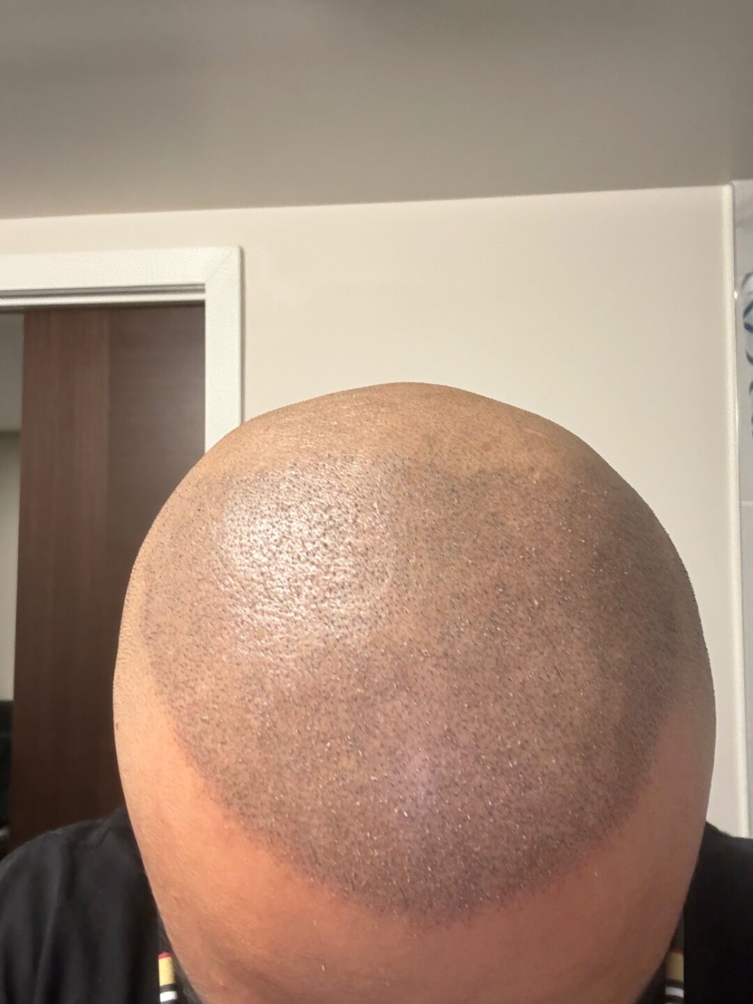 Eugenix | Dr Das | NW7 | 3500 grafts | March 2024 - Hair Transplant ...