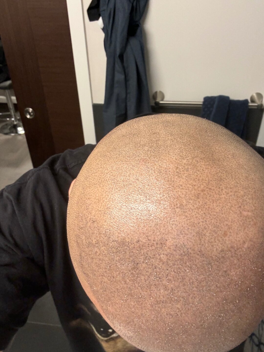 Eugenix | Dr Das | NW7 | 3500 grafts | March 2024 - Hair Transplant ...