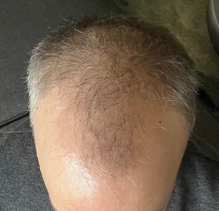Feeling overwhelmed with surgeon choices - Hair Restoration Questions ...