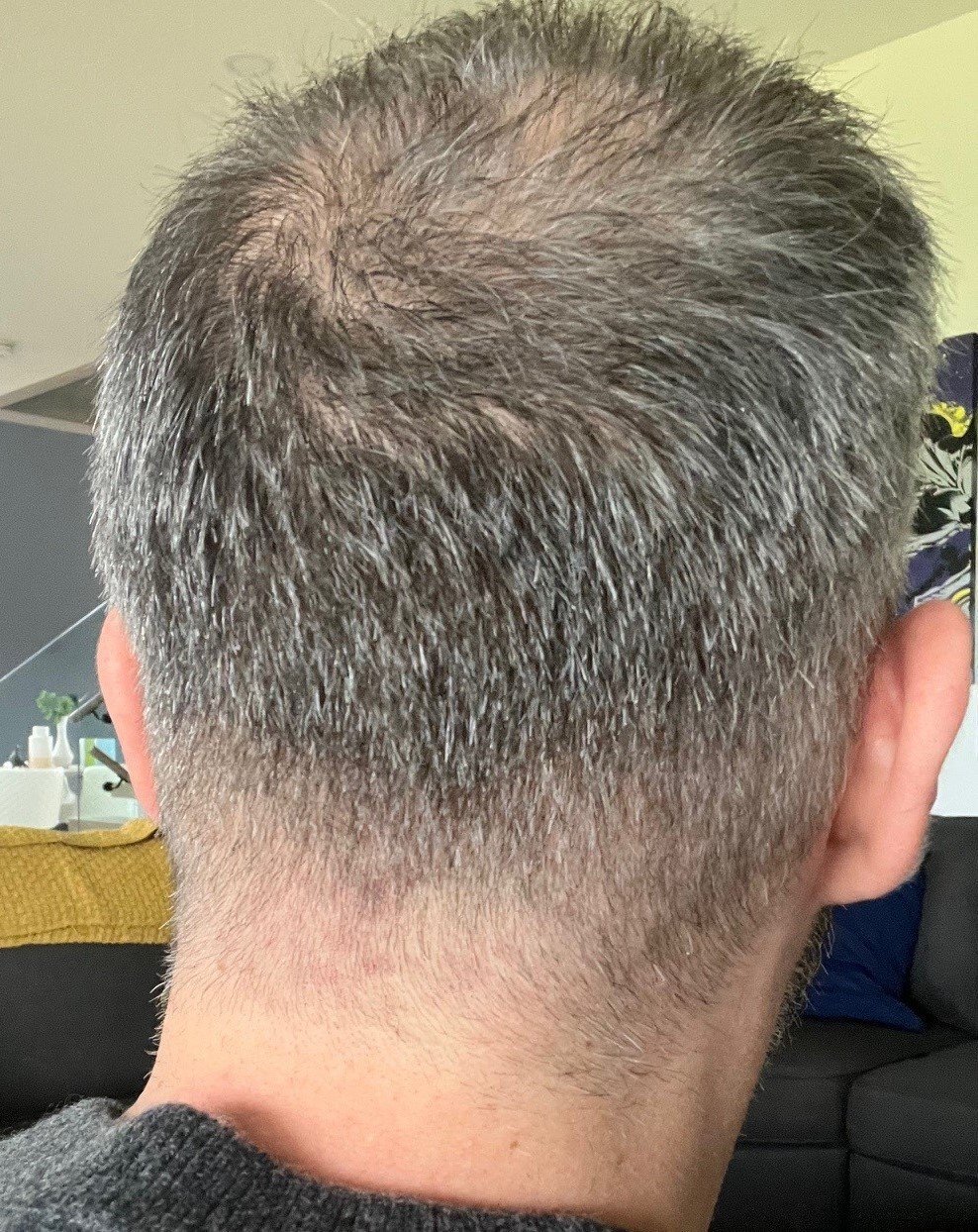 Feeling overwhelmed with surgeon choices - Hair Restoration Questions ...