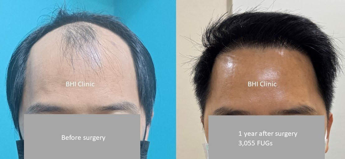 3,055 Grafts FUE hair transplantation and scalp lipoma excision in the ...