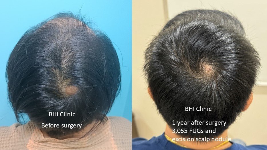 3,055 Grafts FUE hair transplantation and scalp lipoma excision in the ...