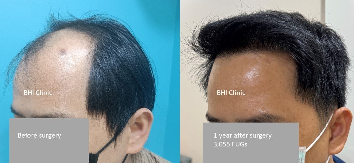 3,055 Grafts FUE hair transplantation and scalp lipoma excision in the ...