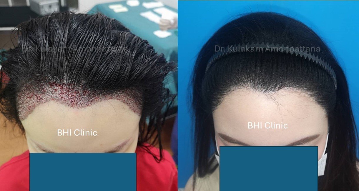 Female hairline rebuilding - FUE hair transplantation - Results Posted ...