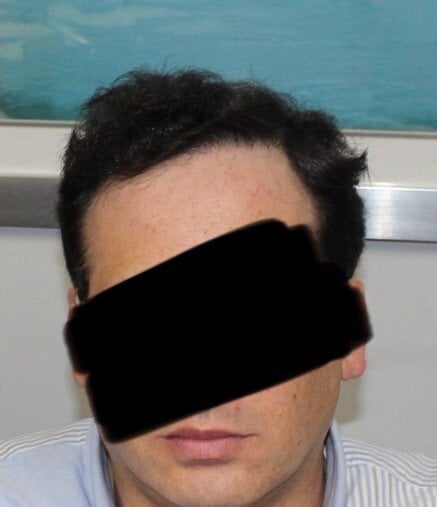 3300 Grafts Dr Bloxham May 2023 - Hair Transplant Reviews - Hair ...