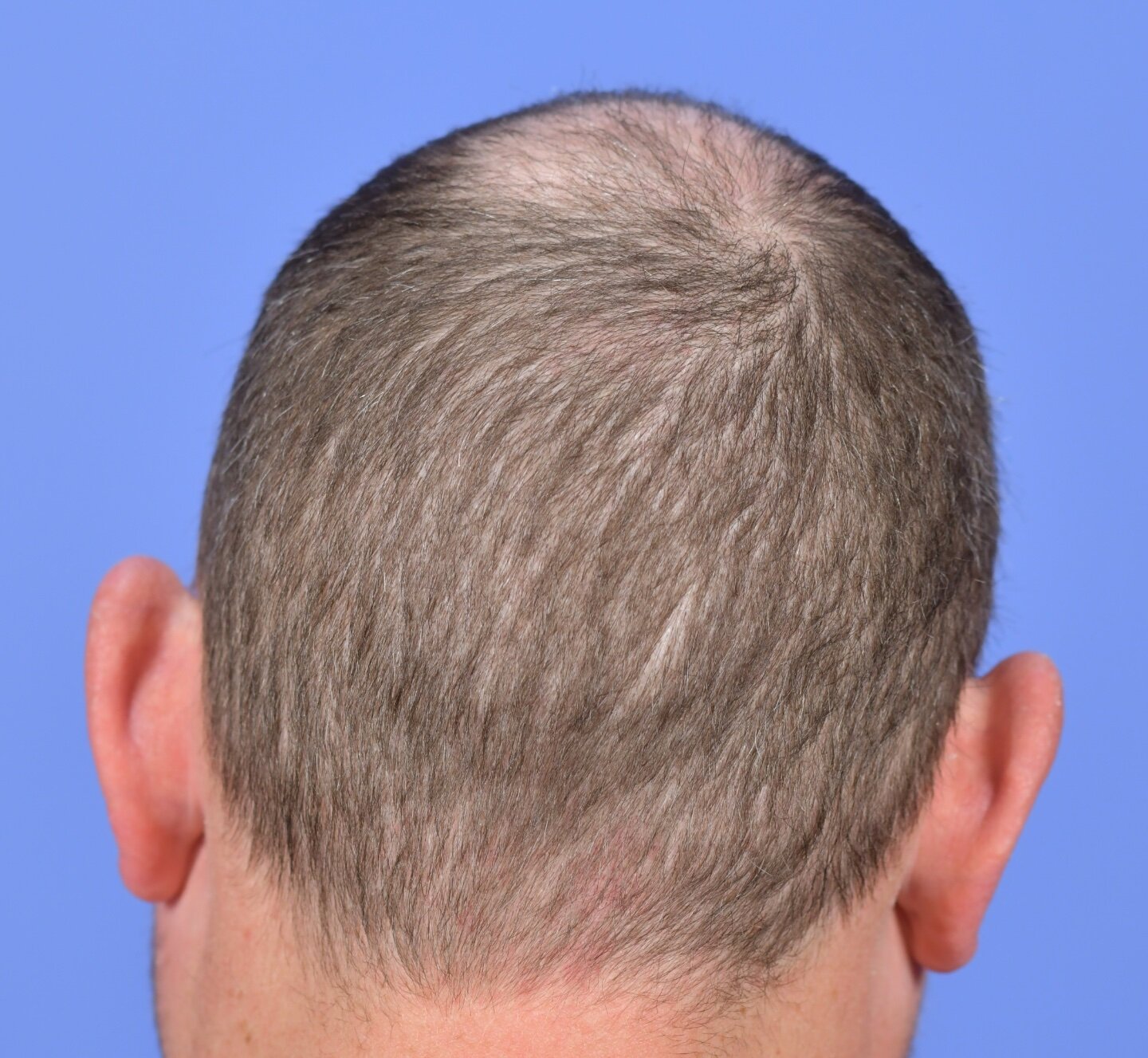 Dr. Steven Gabel - FUE 2,261 grafts - Hair Transplant Reviews - Hair ...