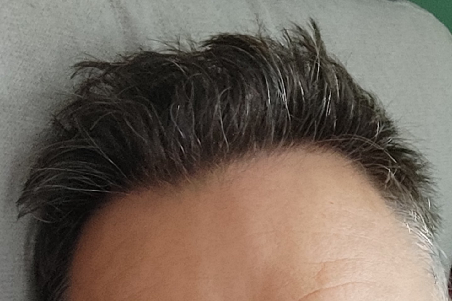 Dr. Georgiou Michalis is he recommended? - Page 2 - Hair Restoration ...