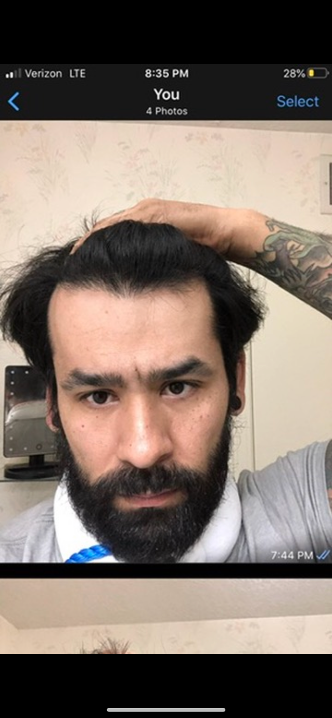 Result from almost 2500 hair grafts - Hair Transplant Reviews - Hair ...