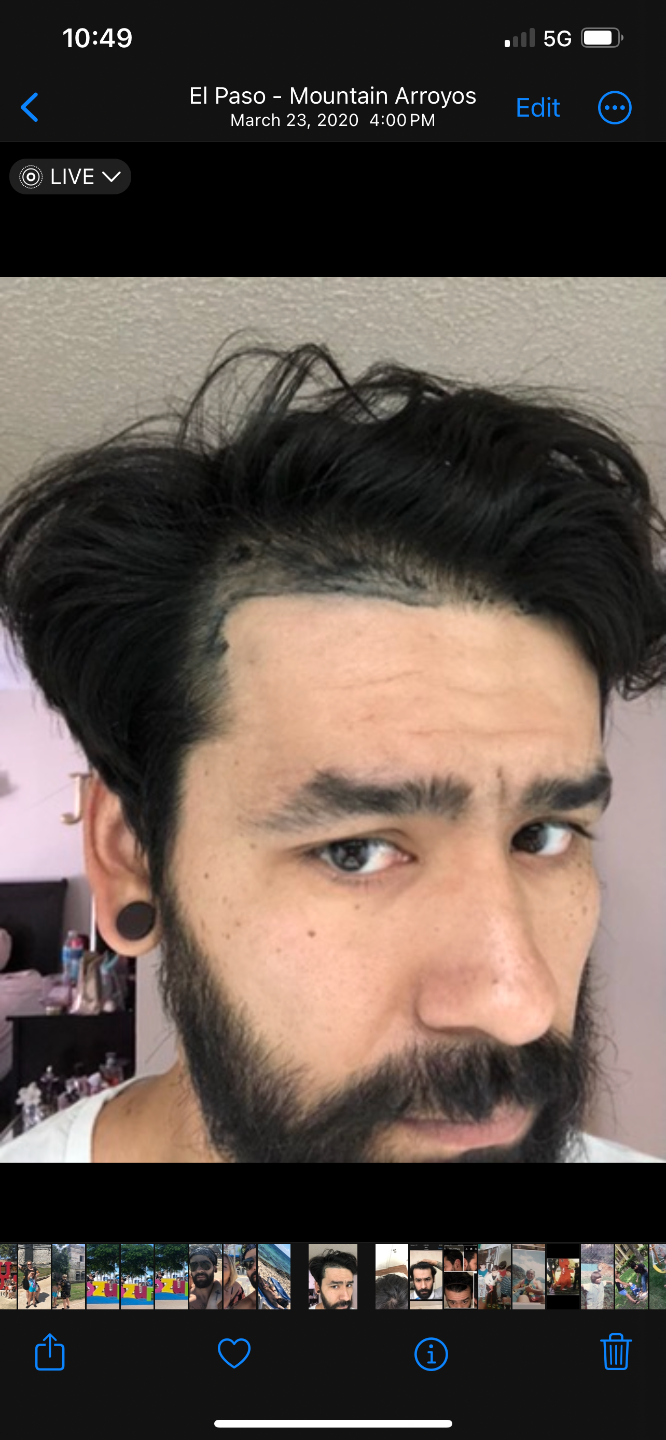 Result from almost 2500 hair grafts - Hair Transplant Reviews - Hair ...