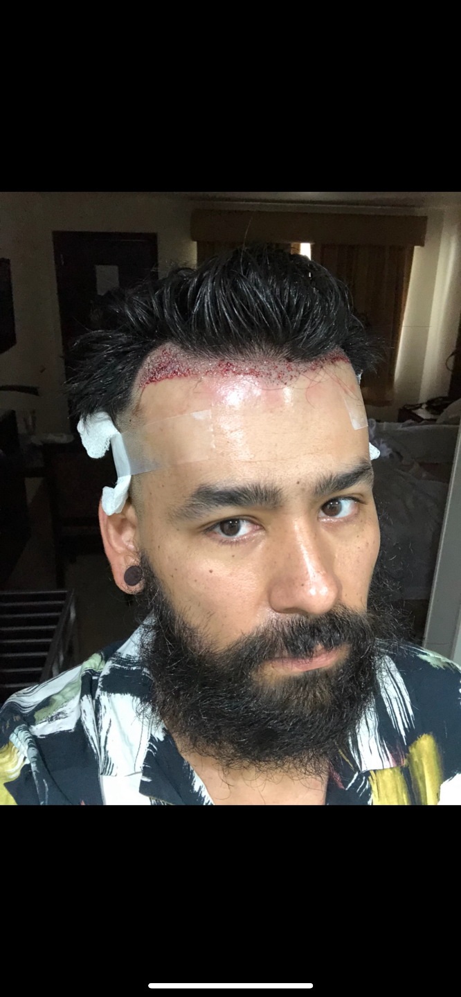 Result from almost 2500 hair grafts - Hair Transplant Reviews - Hair ...