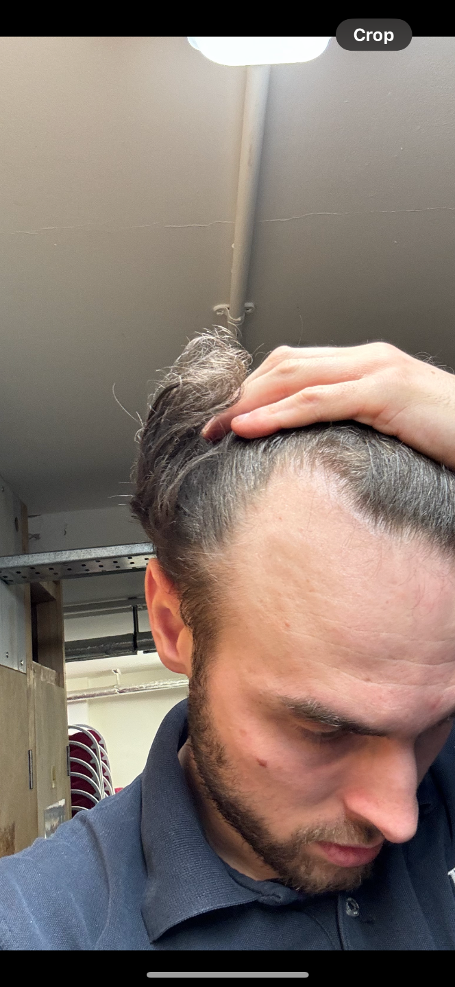 Which clinic or surgeon to use? - Hair Restoration Questions and ...