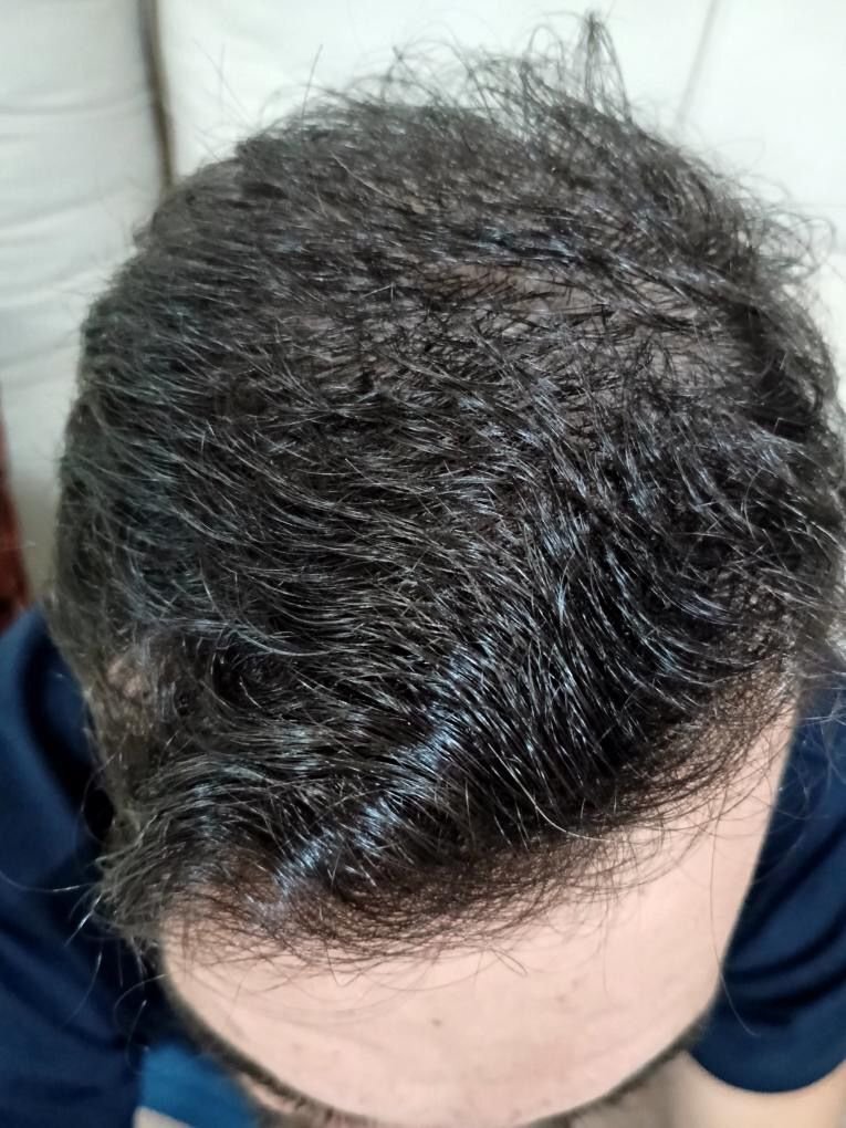 Marcelo Artigoso Schuindt - Hair Restoration Network - Forum For and By ...