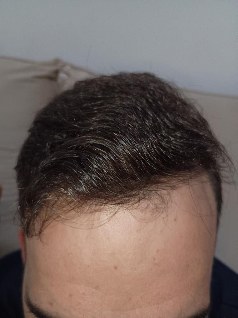 Marcelo Artigoso Schuindt - Hair Restoration Network - Forum For and By ...