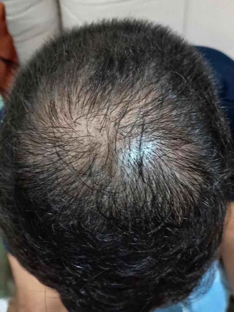 Marcelo Artigoso Schuindt - Hair Restoration Network - Forum For and By ...