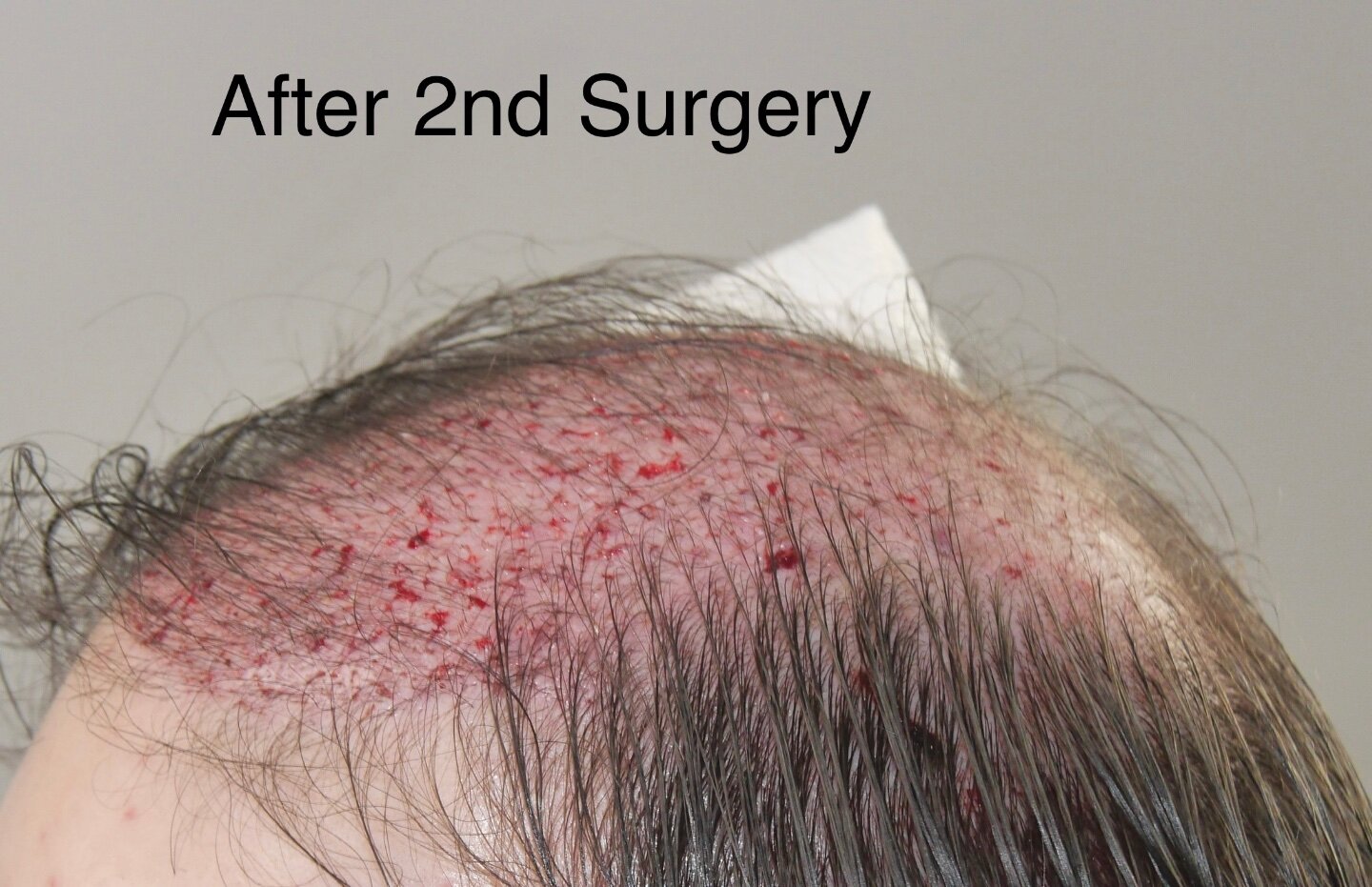 Roughly 5400 Hair Transplant Over 4 Years - Hair Transplant Reviews ...