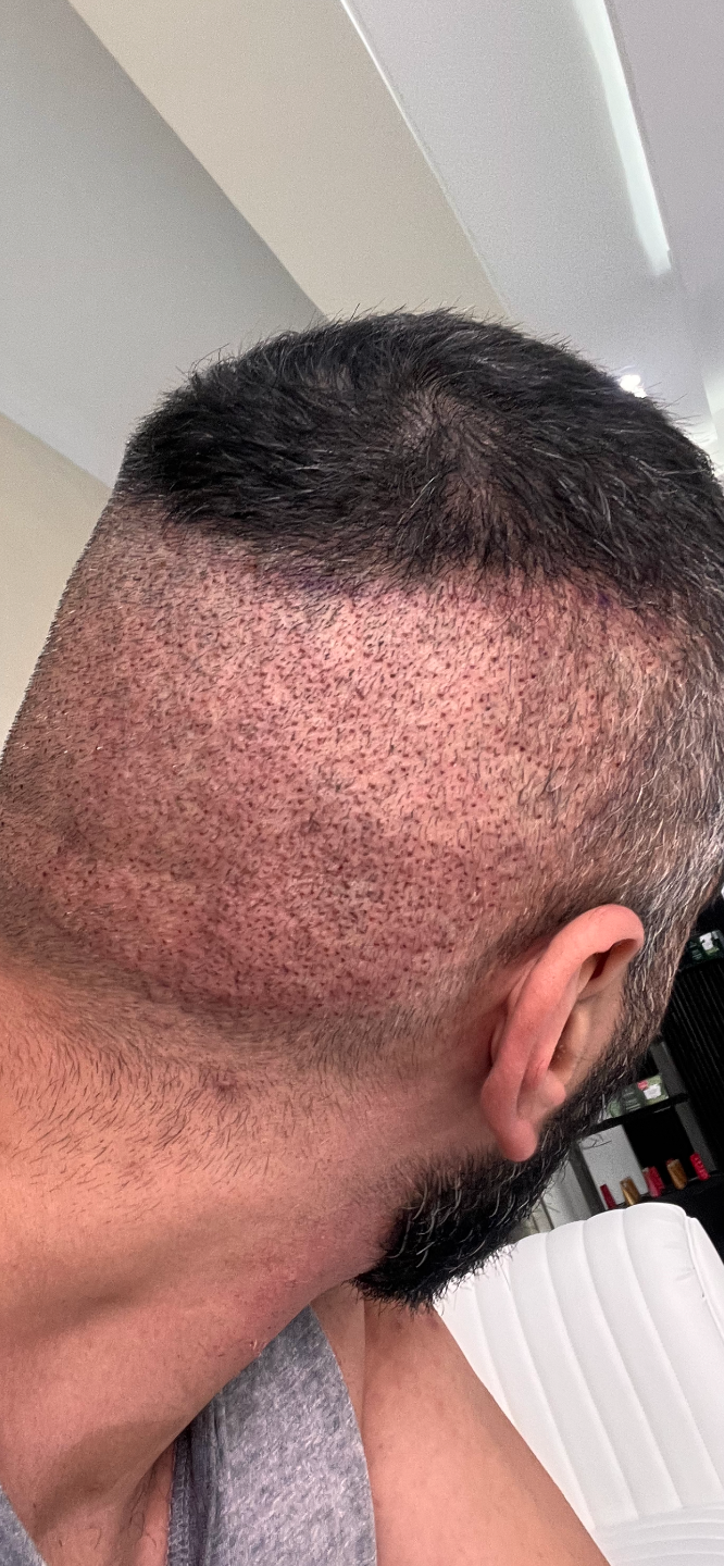 Life totally destroyed after a horrific hair transplant. - Hair ...