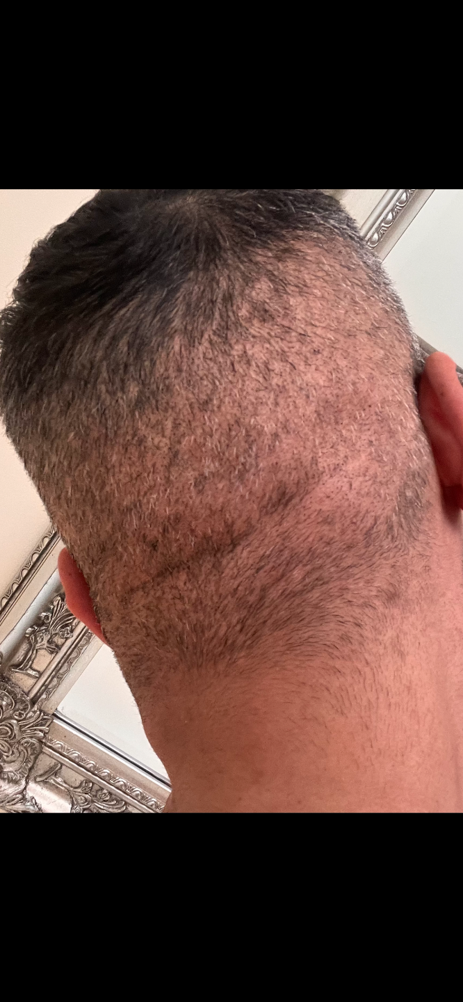 Life totally destroyed after a horrific hair transplant. - Hair ...