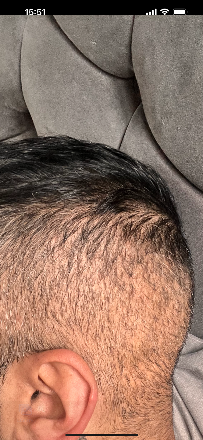Life totally destroyed after a horrific hair transplant. - Hair ...