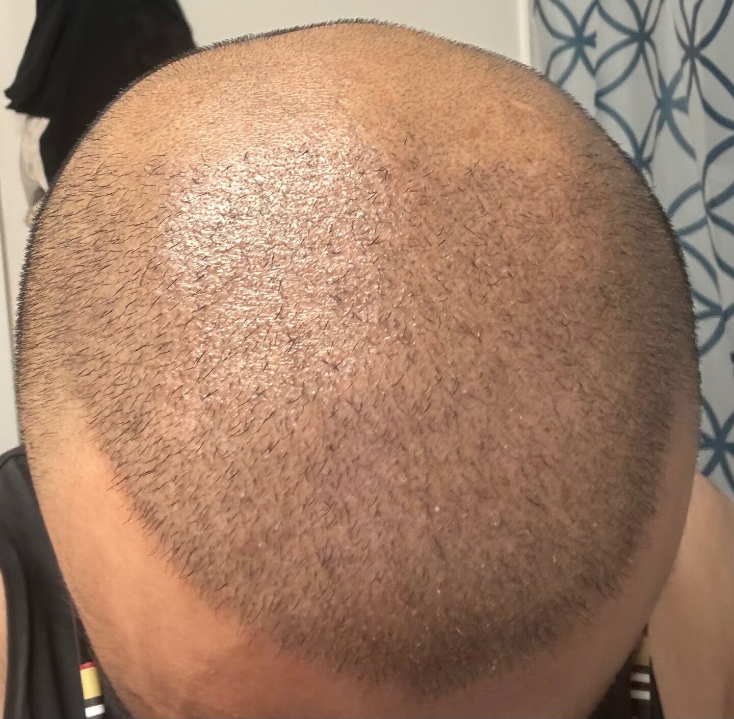 Eugenix | Dr Das | NW7 | 3500 grafts | March 2024 - Hair Transplant ...