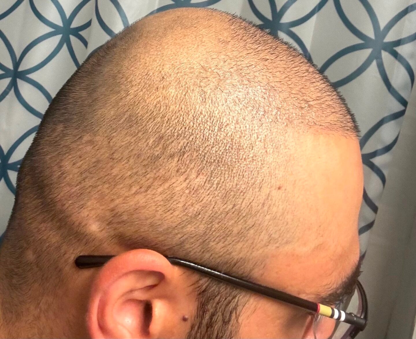 Eugenix | Dr Das | NW7 | 3500 grafts | March 2024 - Hair Transplant ...