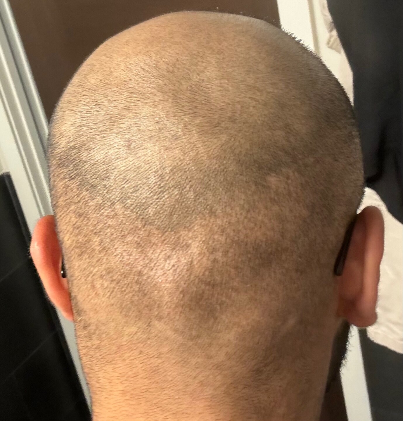 Eugenix | Dr Das | NW7 | 3500 grafts | March 2024 - Hair Transplant ...