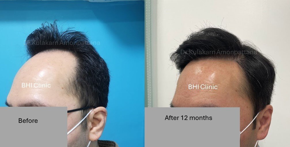 Frontal hair line and crown filled up- Dr. Kulakarn Amonpattana - BHI ...