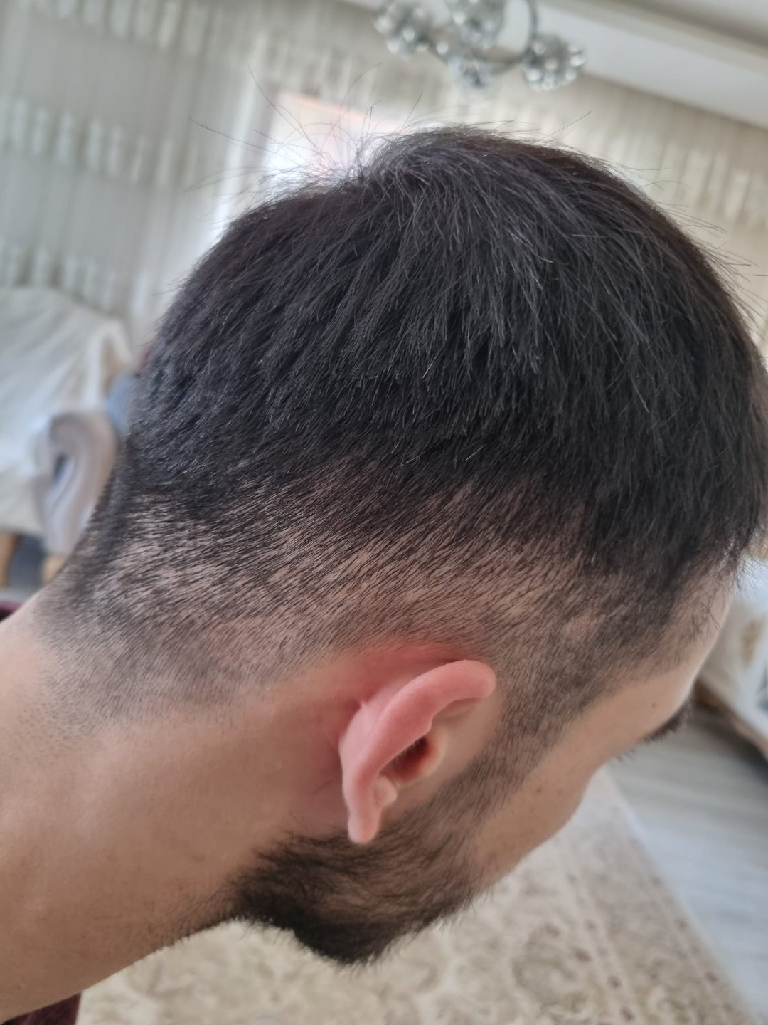 Botched transplant, I don't know what to do, need your helps - Hair ...