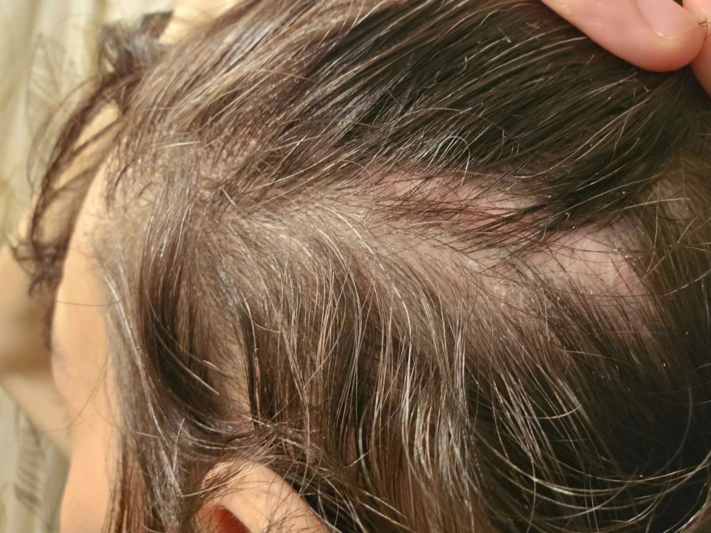 Dr. Bloxham - 2,912 Grafts - FUT - August 2023 - Hair Transplant ...